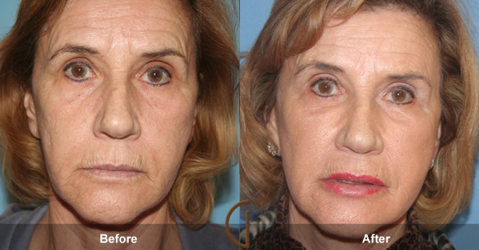 Lose Chin Fat Dissolver By Consuming More Water - Practical ...